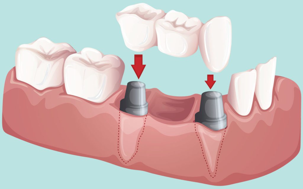 Dental Bridges - Tooth Bridge Procedure - Visalia Dentist