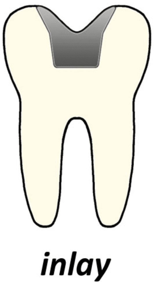Inlays, Onlays, and Partial Crowns - Visalia Dentist